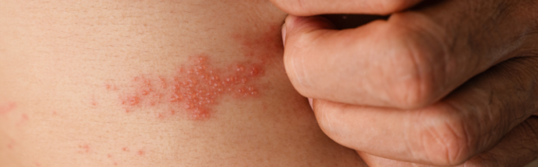 Paardenmiddel tegen netelroos | Fix de jeuk | Perfect Age