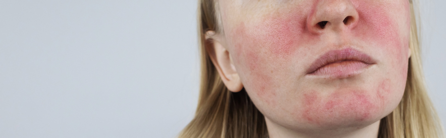 Rode en gevoelige huid - perfect-age.com